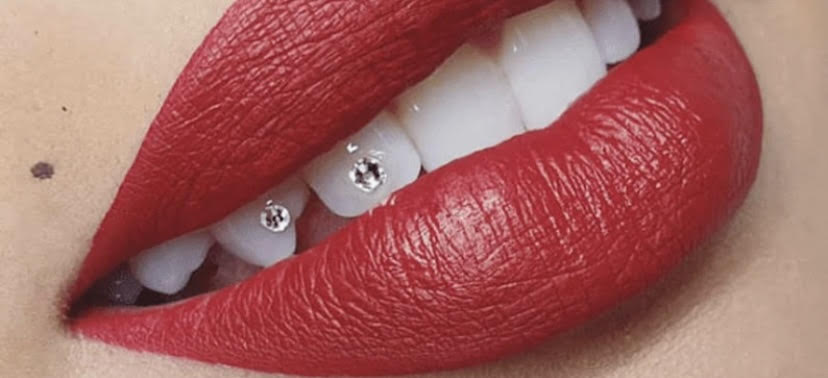 Teeth Gems – Urban Smiles Ottawa