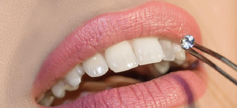 Teeth Gems – Urban Smiles Ottawa